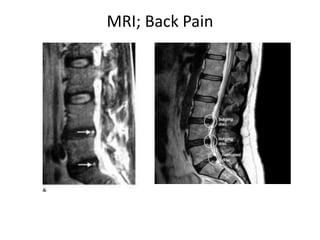Discogenic back pain:Non-operative treatment by Dr Ashok Jadon,MD FIPP ...