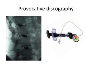 Discogenic back pain:Non-operative treatment by Dr Ashok Jadon,MD FIPP ...