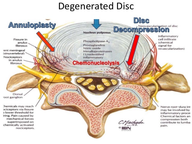 Discogenic back pain:Non-operative treatment by Dr Ashok Jadon,MD FIP…