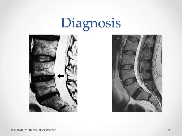 Discogenic low back pain | PPTX