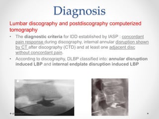 Discogenic low back pain | PPTX