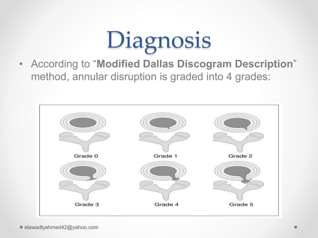 Discogenic low back pain | PPTX