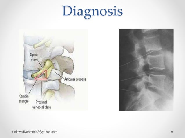 Discogenic low back pain | PPTX
