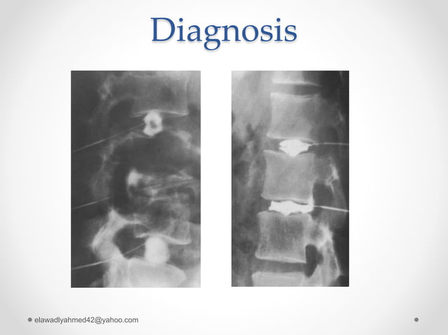 Discogenic low back pain | PPTX