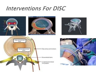 Discogenic pain | PPT