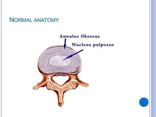 Discograpgy (intradiscal procedure) | PPTX