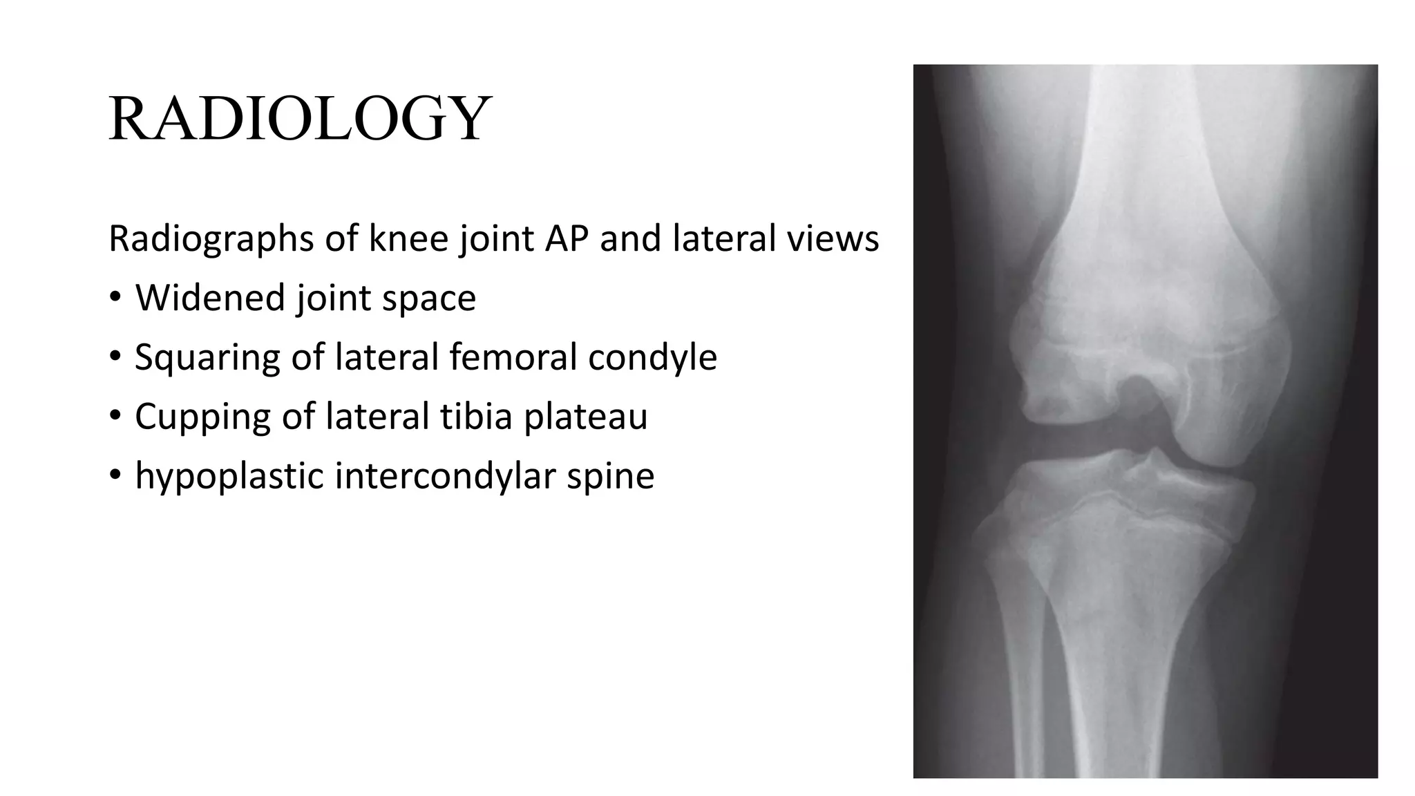 Discoid meniscus | PPTX