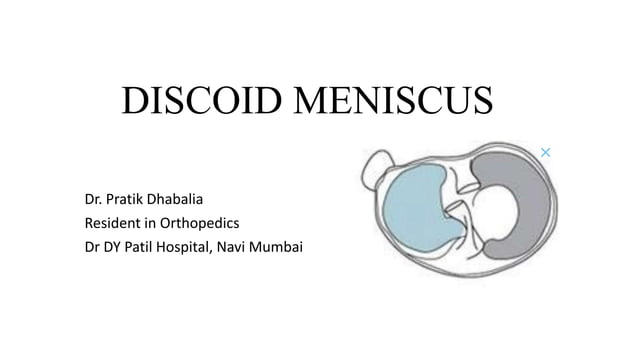 Discoid meniscus | PPTX | Death, Injury, or Military Conflict ...