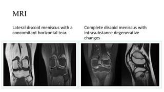 Discoid meniscus | PPTX