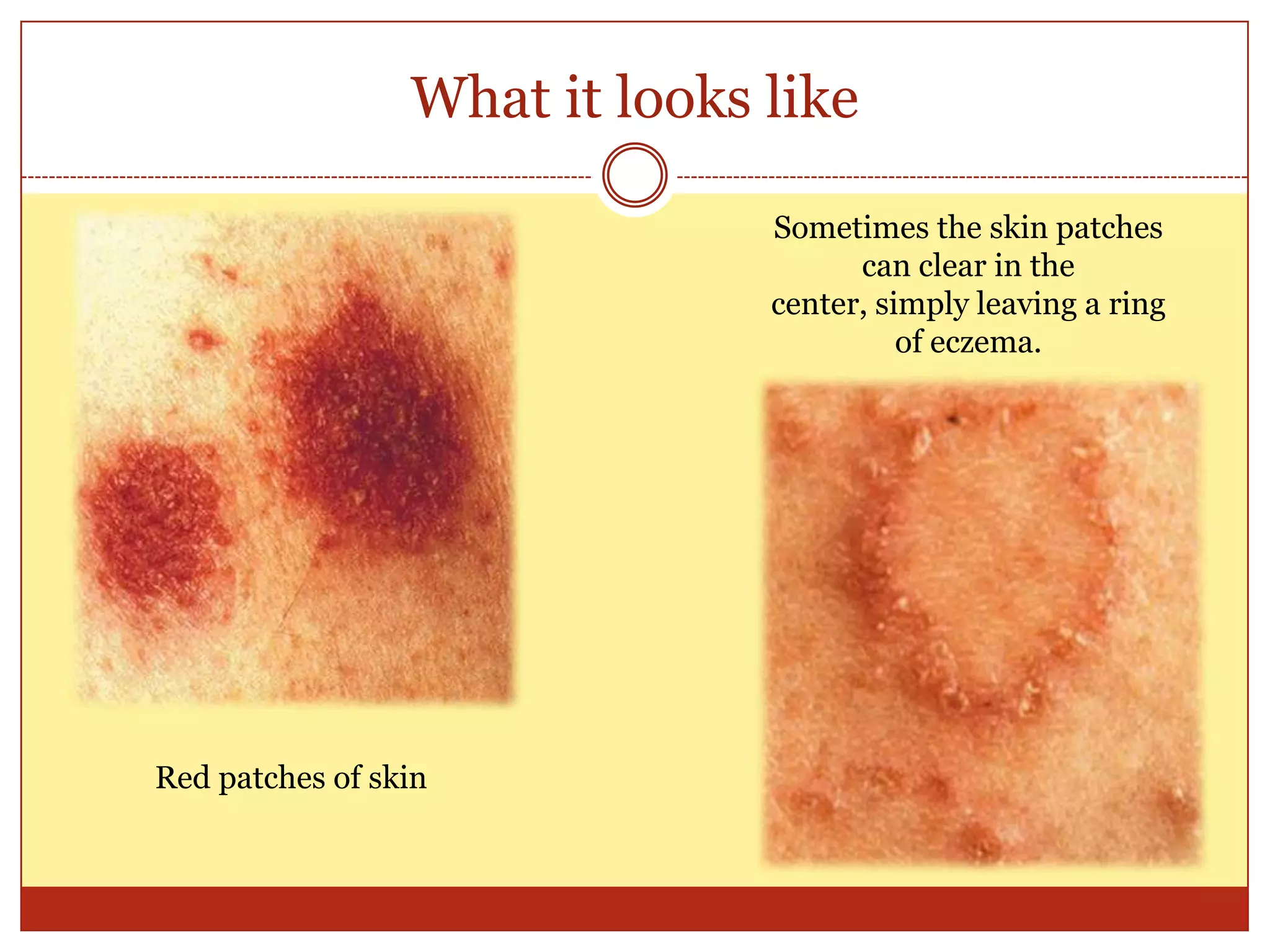 Discoid eczema | PPTX