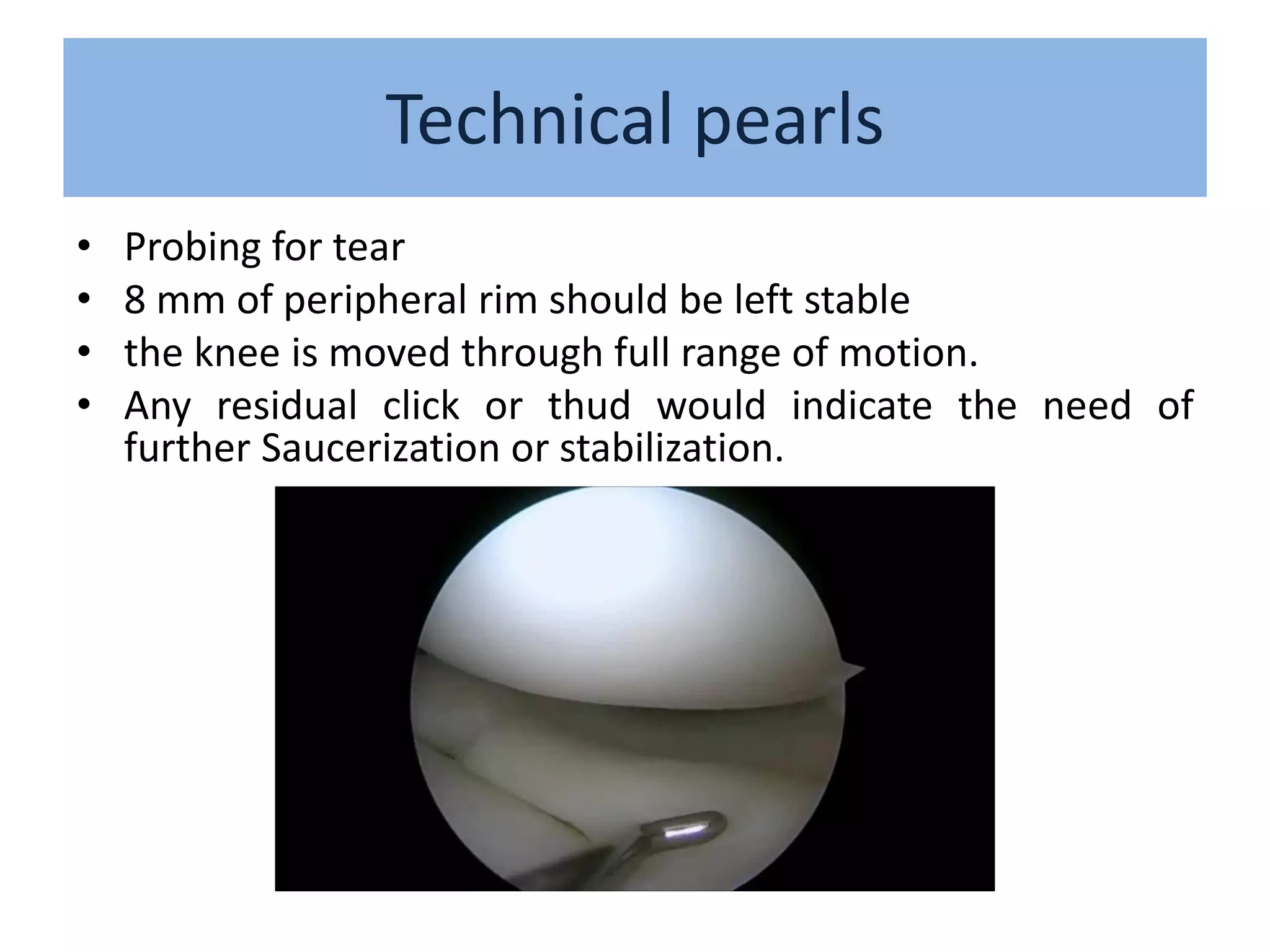 Discoid meniscus | PDF