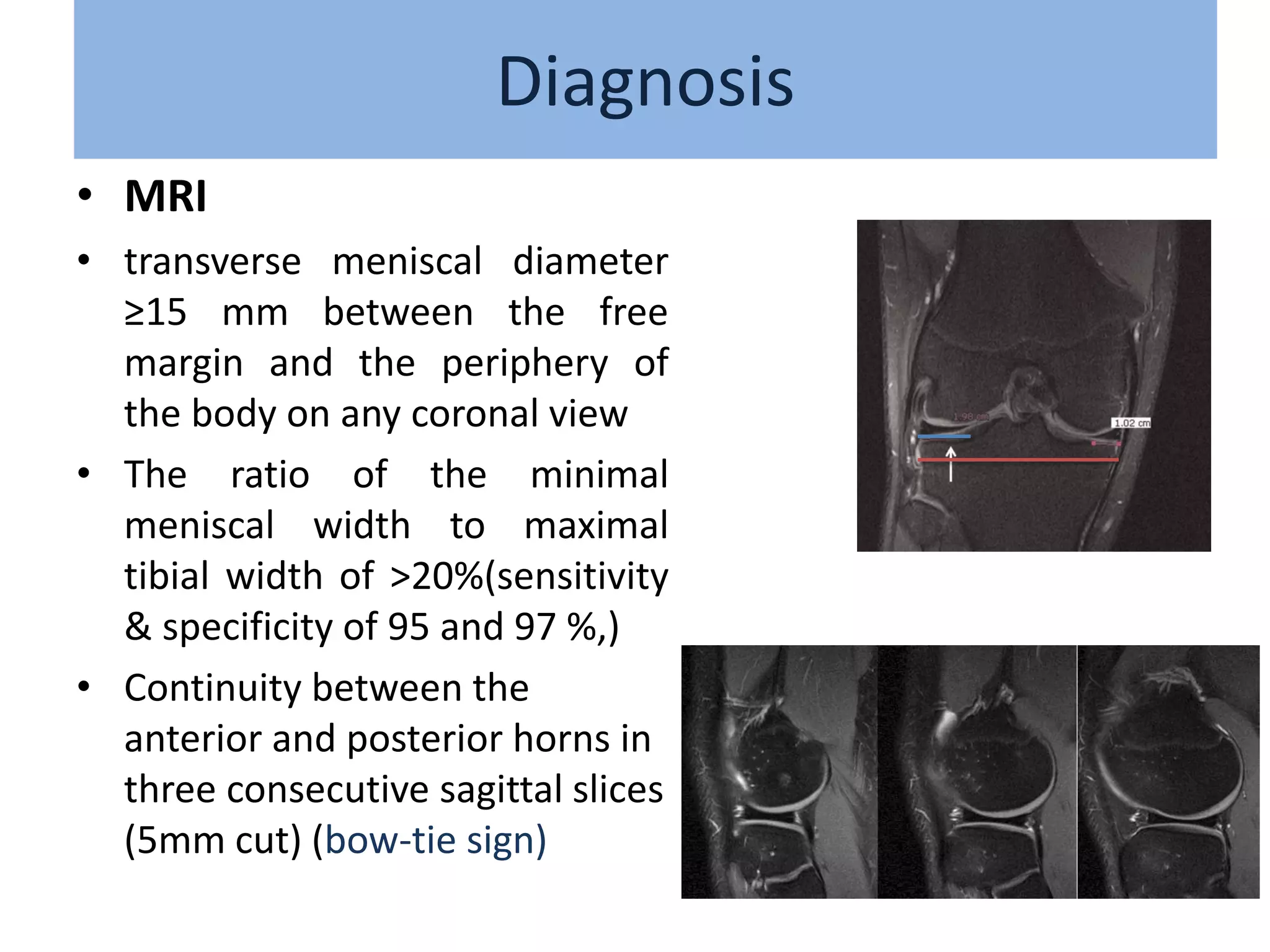 Discoid meniscus | PDF