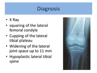 Discoid meniscus | PPT