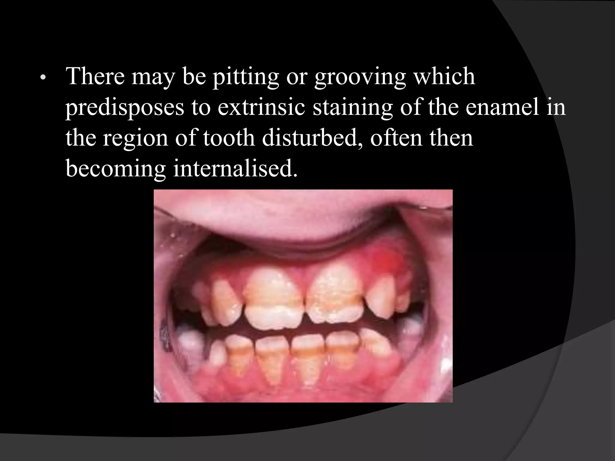 TOOTH DISCOLORATION AND BLEACHING | PPTX