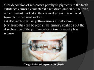 TOOTH DISCOLORATION AND BLEACHING | PPTX