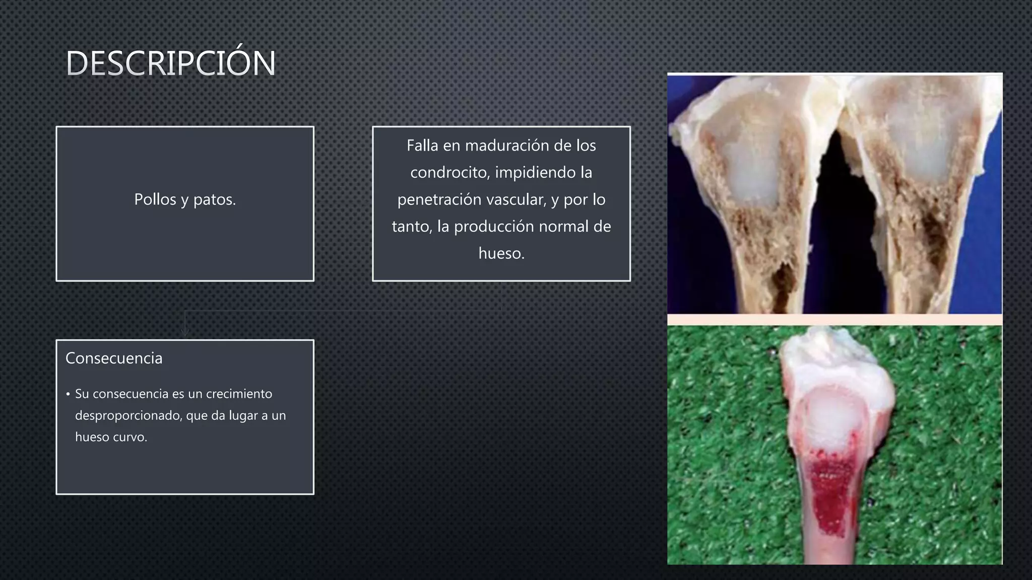 Discondrosplasia tibial | PPTX
