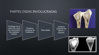 Discondrosplasia tibial | PPTX