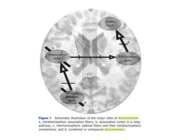 Disconnection syndrome | PPTX