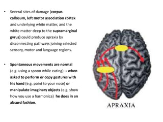 Disconnection syndromes sharath | PPTX