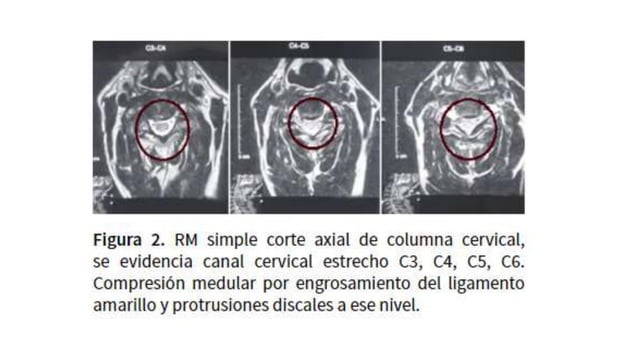 Discopatia cervical | PPTX