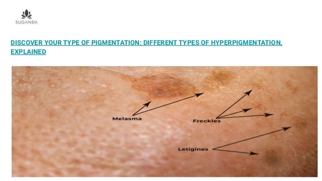 DISCOVER YOUR TYPE OF PIGMENTATION: DIFFERENT TYPES OF ...