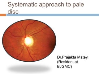Neovascular Glaucoma