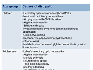 Ms And Pallor Optic Nerve