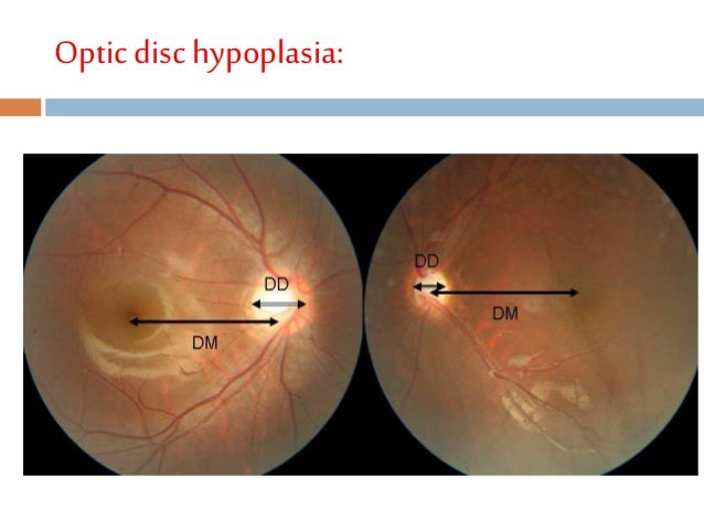 approaches to pale disc