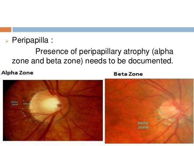 Approaches To Pale Disc