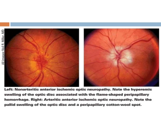 approaches to pale disc