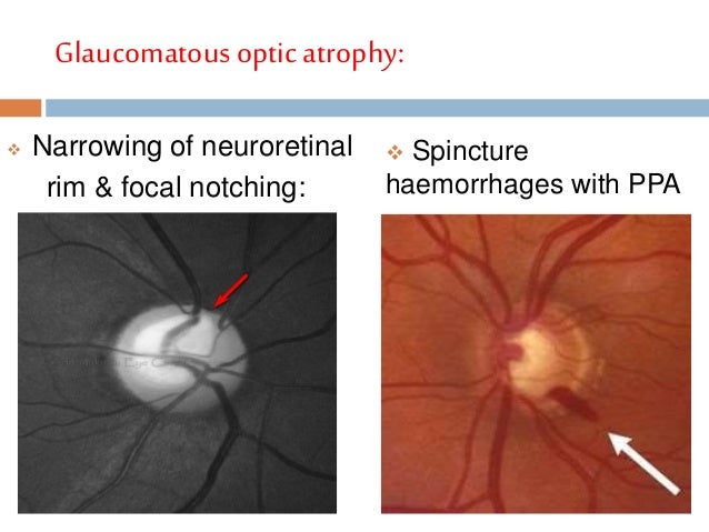 Optic Nerve Cupping Notching