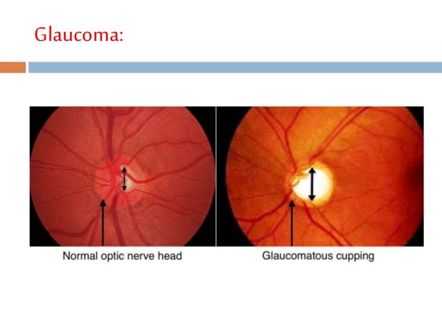 approaches to pale disc