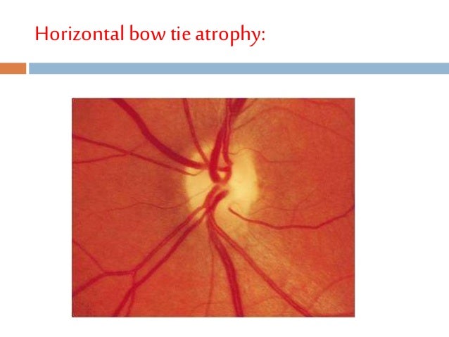 approaches to pale disc