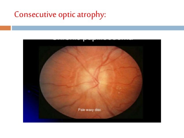 approaches to pale disc