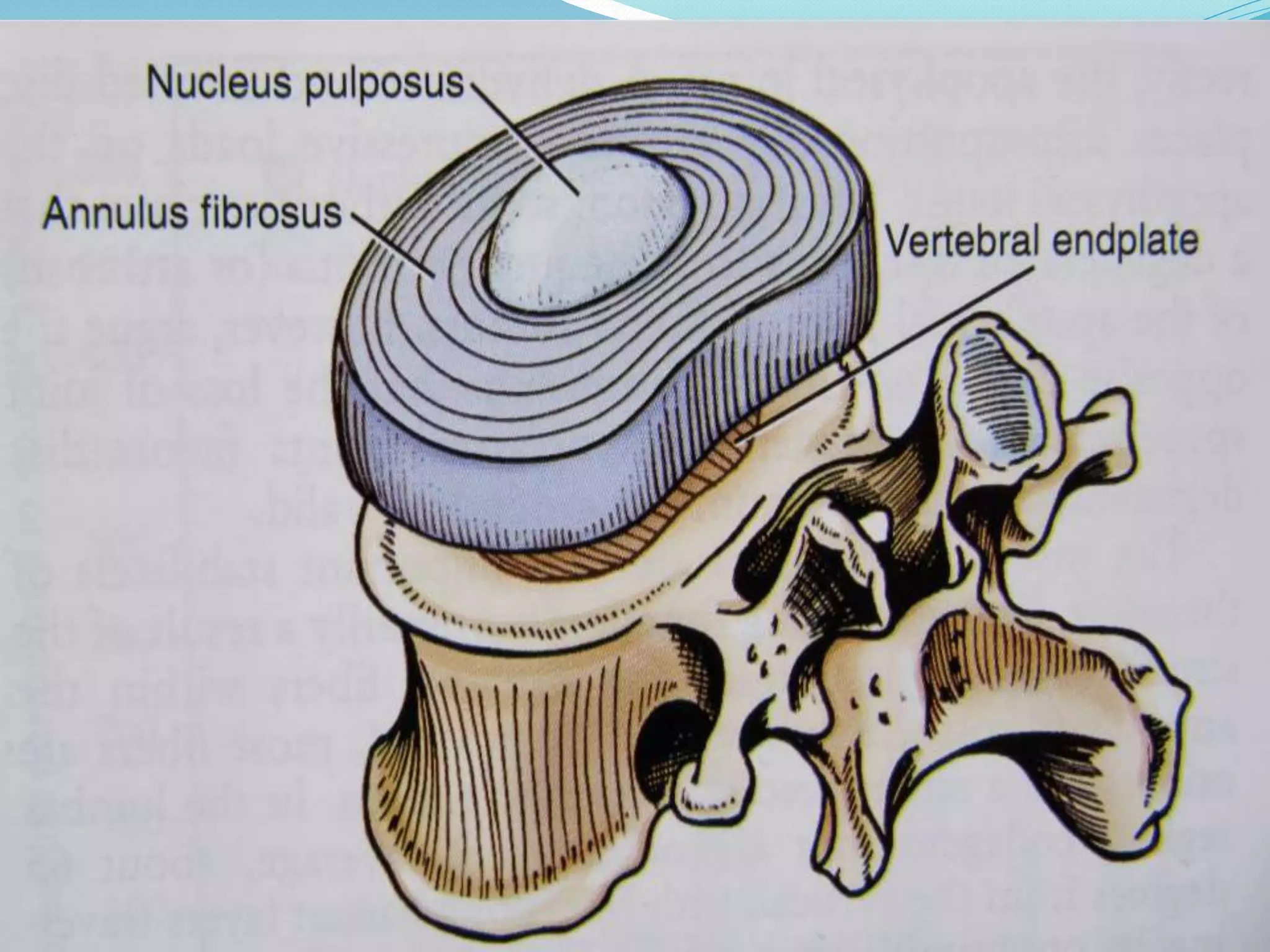 Disc prolaps and rehabilitation | PPTX