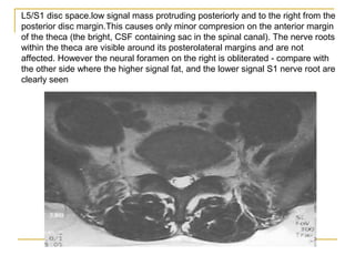 Disc prolapse and degenerative changes | PPT