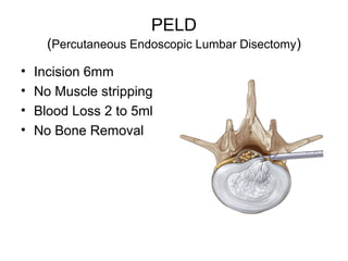 Disc prolapse (sciatica) | PPT