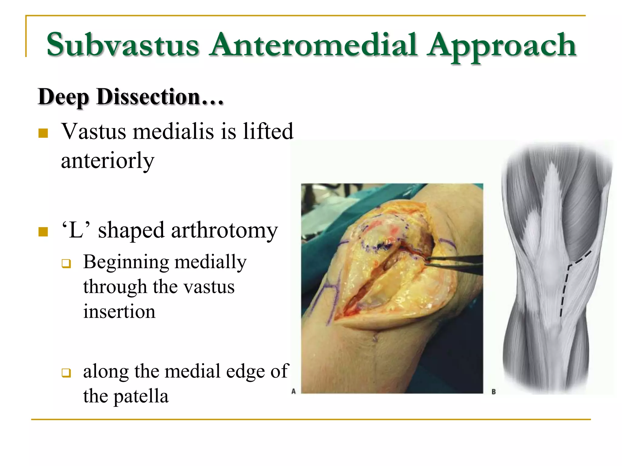 Discuss approaches to the knee and Describe in detail TKR | PPTX ...