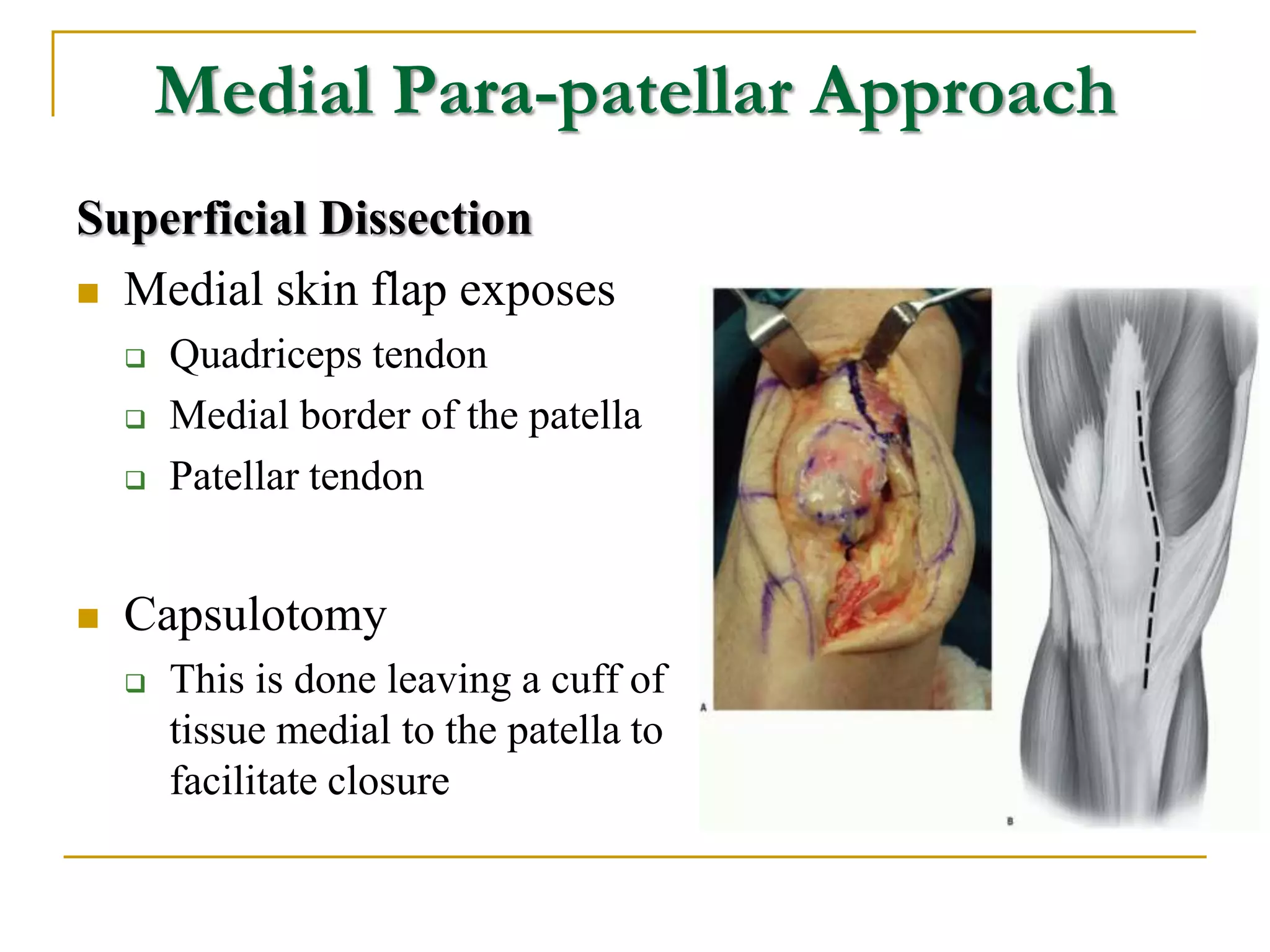 Discuss approaches to the knee and Describe in detail TKR | PPTX