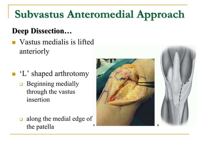 Discuss approaches to the knee and Describe in detail TKR | PPTX ...