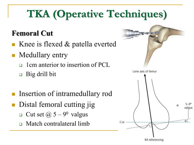Discuss approaches to the knee and Describe in detail TKR | PPTX ...