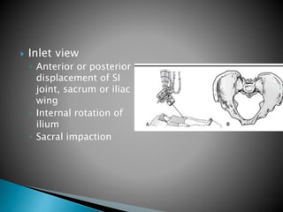 Discuss classifications and management of pelvic injury | PPTX