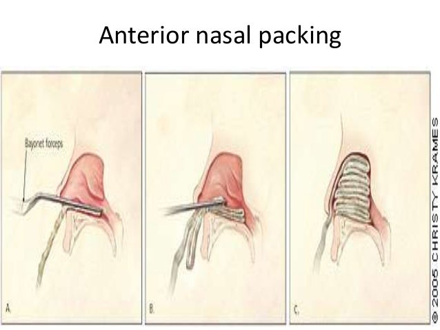 Discuss epistaxis kbth