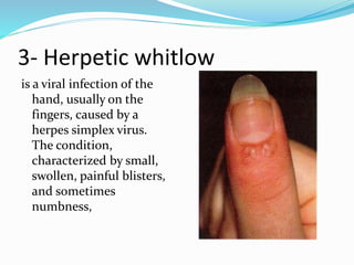 Staphylococcal Whitlow