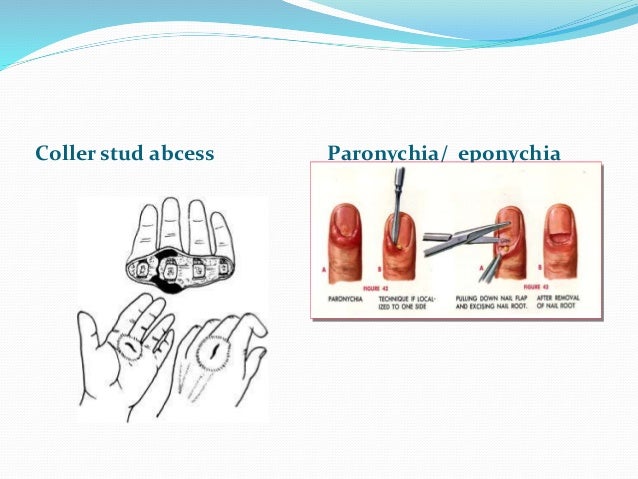 Discuss hand infection (2)