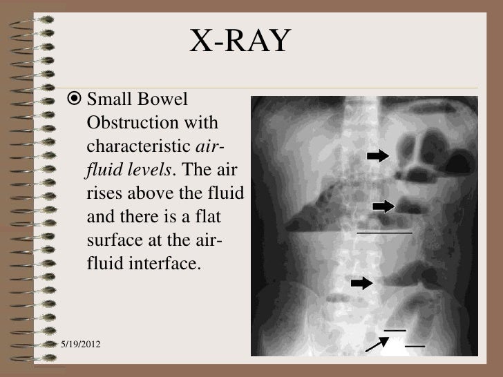 Discuss intestinal obstruction