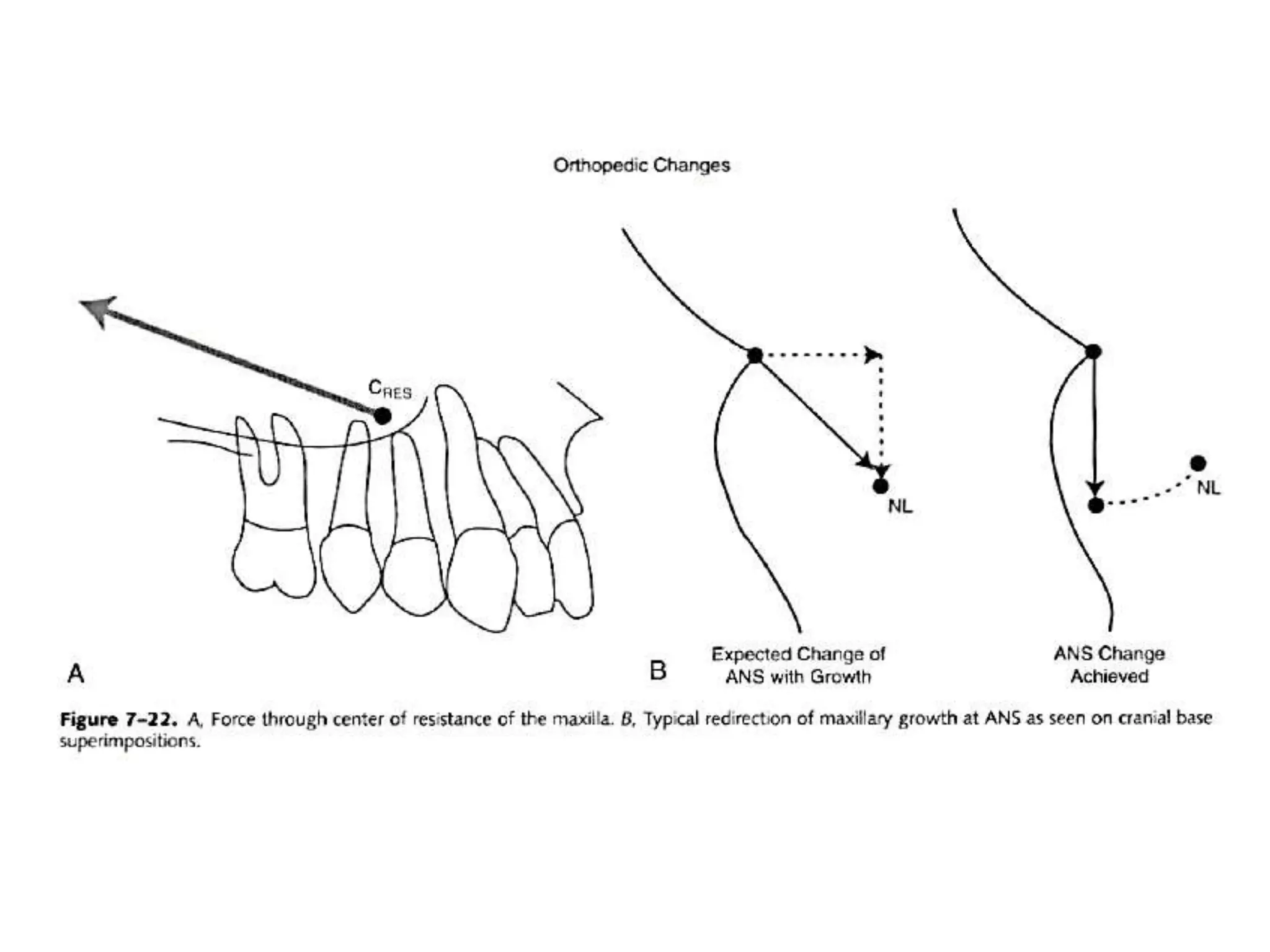 Biomechanics of Headgears | PPTX