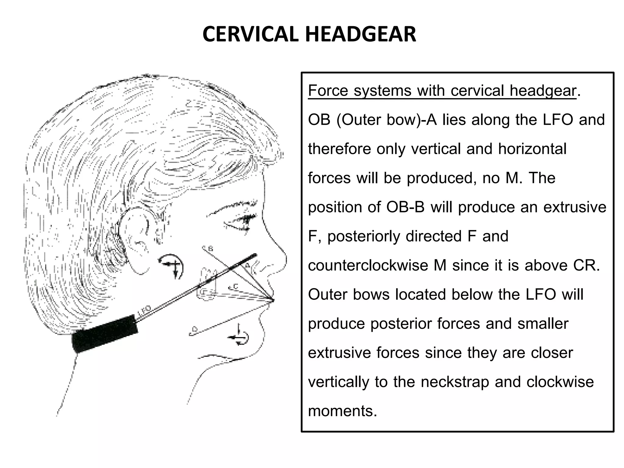 Biomechanics of Headgears | PPTX