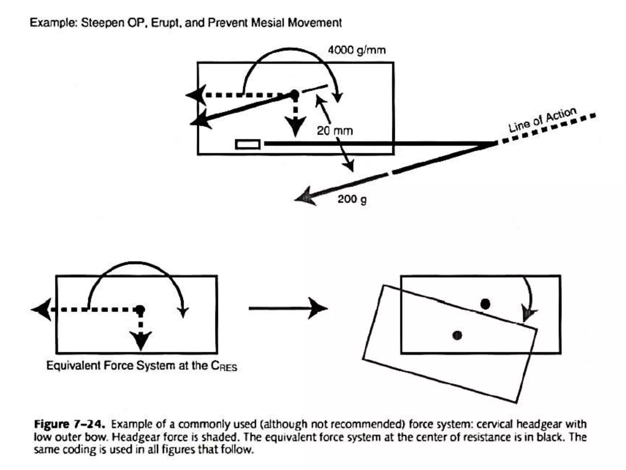 Biomechanics of Headgears | PPTX