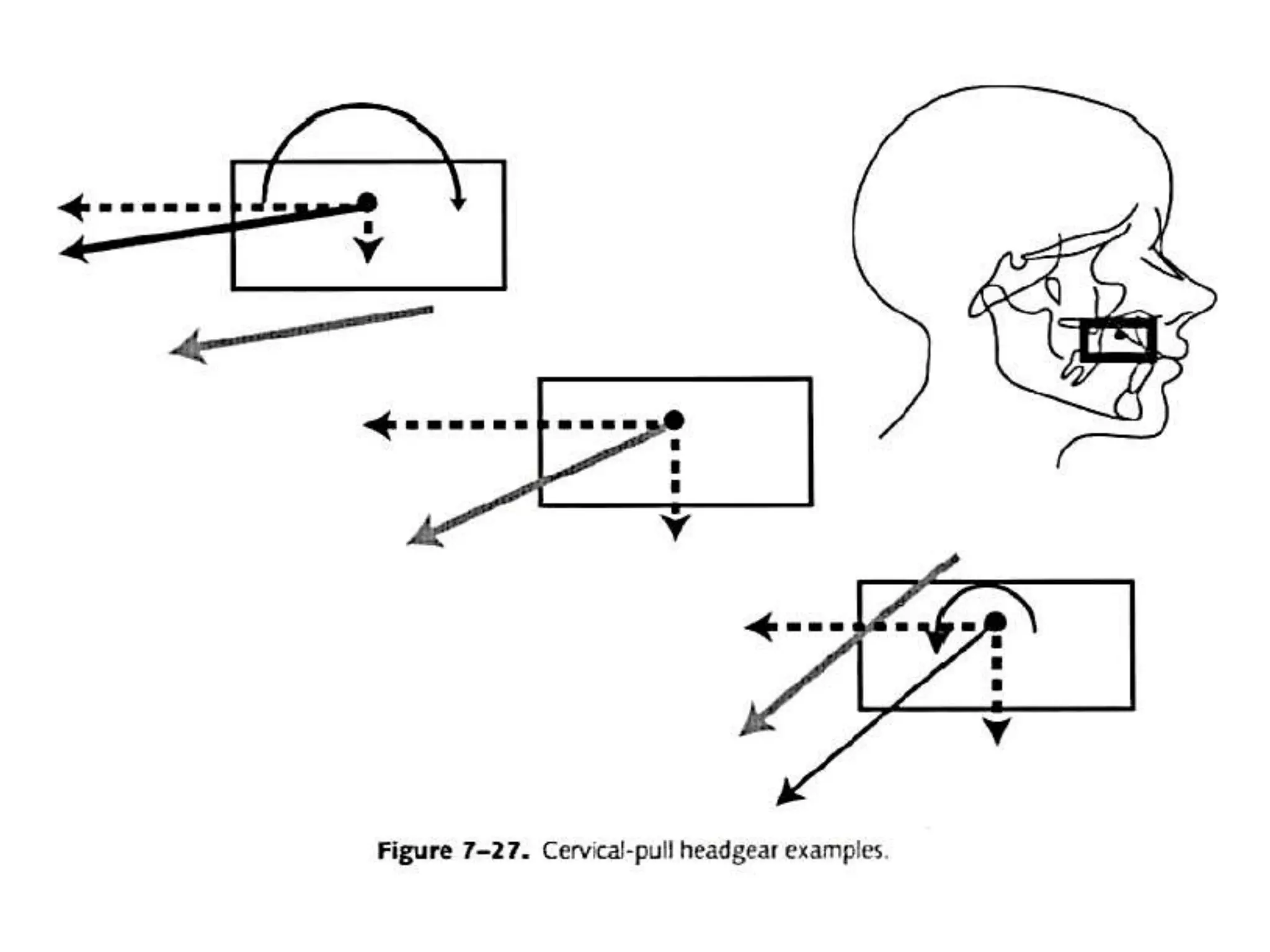Biomechanics of Headgears | PPTX